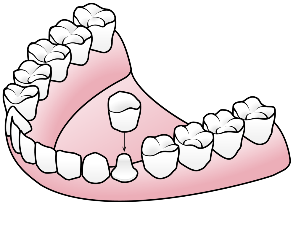 Products | Nexgen Dental Laboratory Inc. ::: Lutz, FL